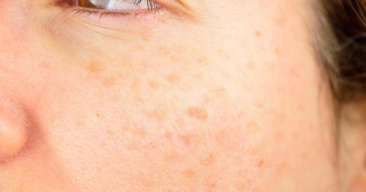 Rimuovere le macchie cutanee con il laser | Clinica Marchetti