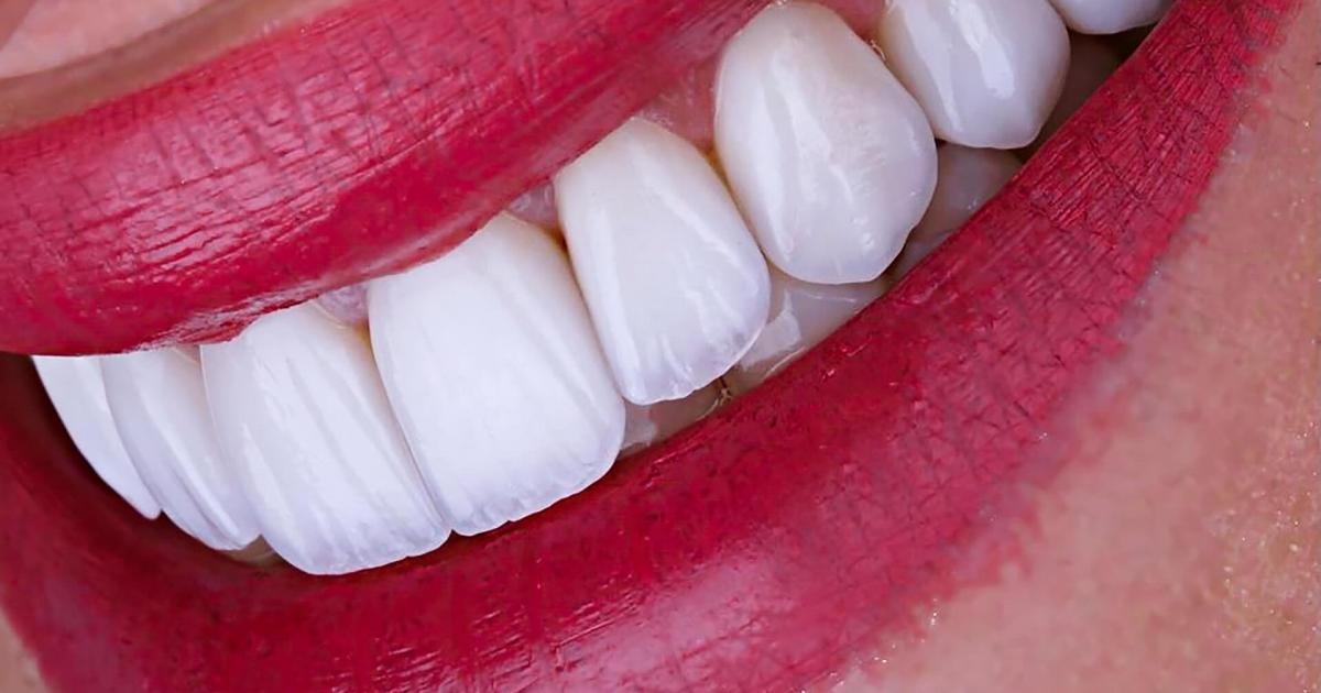 Le faccette dentali in ceramica feldspatica | Clinica Marchetti