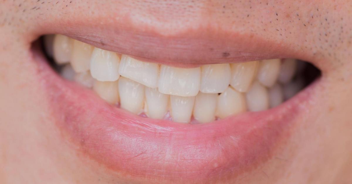 Ricostruzioni dentali dirette | Clinica Marchetti